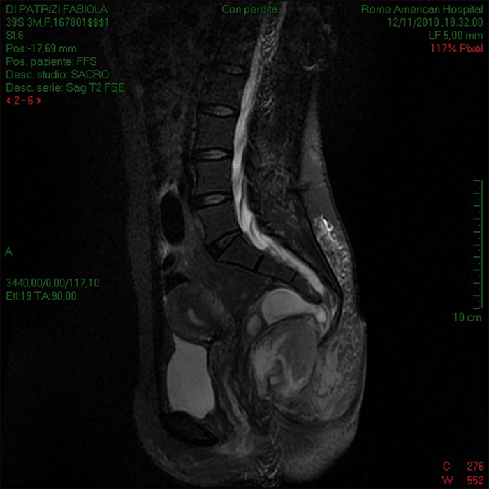 Rare Care of Retrorectal Abscess and Meningocele | ACS