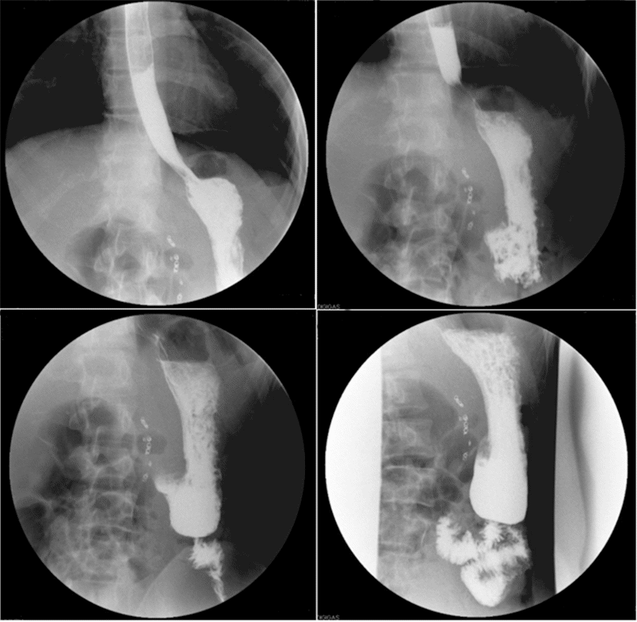 Robotic Gastrojejunostomy to Treat Superior Mesenteric Artery Syndrome ...