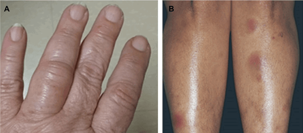Primary Acinar Cell Carcinoma of the Liver Complicated by Pancreatic ...