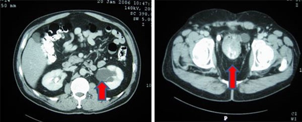 Signet-Ring Cell Cancer of Colon 48 Years after Ureterosigmoidostomy ...
