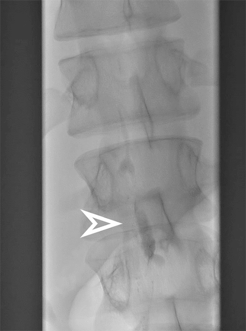 Repeat Thoracic Duct Embolization in Traumatic Thoracic Duct Injury: An ...