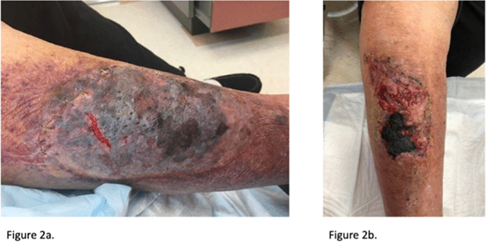A Novel Technique: In Situ Autologous Skin Graft to Manage Traumatic ...