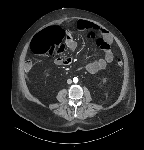 Cecal Bascule Following a Small Bowel Resection for Meckel’s ...
