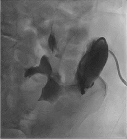 Endoscopic Management of Delayed Duodenojejunal Marginal Ulcer ...