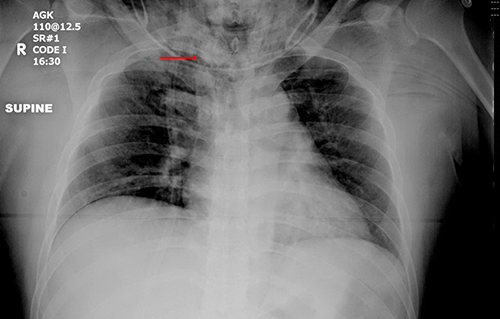 Complex Intrathoracic Tracheal Injury: A Challenging Case for Trauma ...