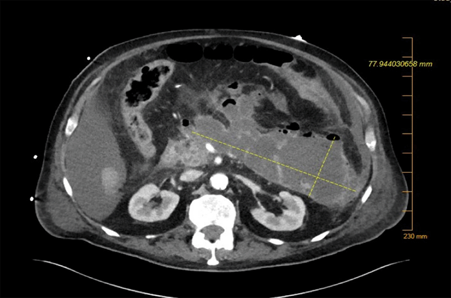 COVID-19 Patient Presenting With Total Pancreatic Necrosis and ...
