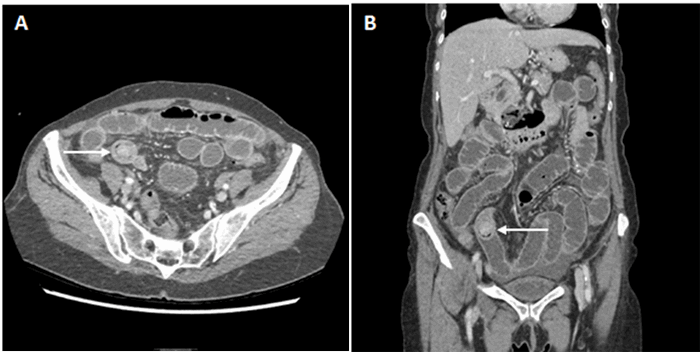 Gallstone Ileus and Meckel’s Diverticulum in a Virgin Abdomen | ACS