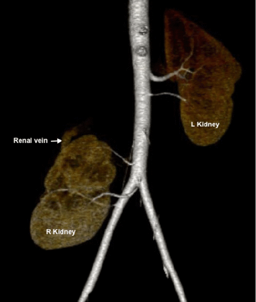 Transplantation of a Pelvic Kidney from a Living Donor Using a ...