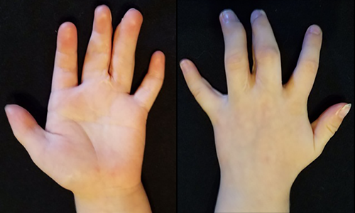 Syndactyly Repair with a Straight-Line Technique: A Case Series | ACS