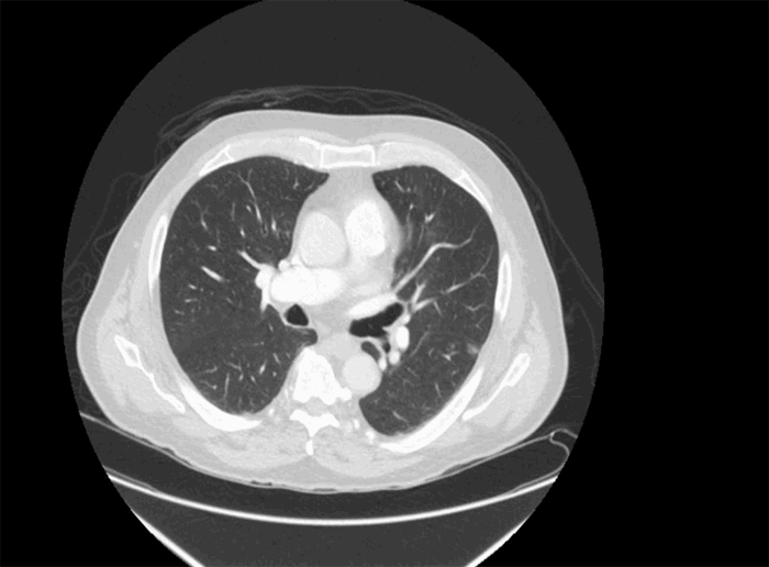 Rendezvous Procedure as an Alternative Treatment Strategy for Type C ...