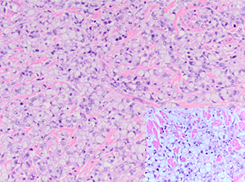 Signet Ring Cell Carcinoma of the Breast: An Aggressive Tumor | ACS