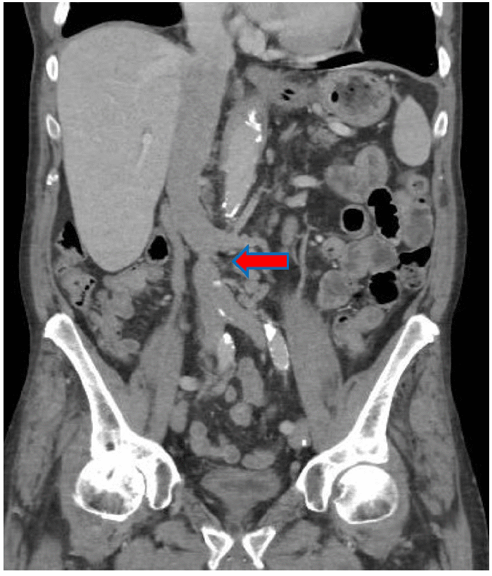 Inverted Donor Inferior Vena Cava Conduit to Bypass an Inferior Vena ...
