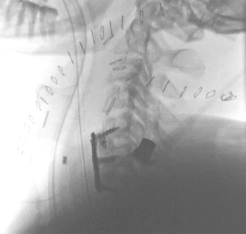 Retained Bullet in the Spinal Canal and Vertebral Artery Transection | ACS