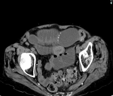 Recurrent Small Bowel Obstruction Due to Jejunal Diverticular ...