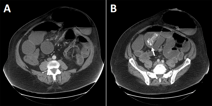 Complete Mesh Migration Into the Small Bowel Following Parastomal ...