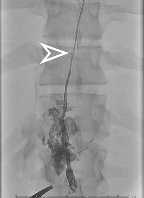 Repeat Thoracic Duct Embolization in Traumatic Thoracic Duct Injury: An ...