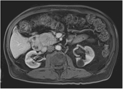Malrotation Identified during Pancreaticoduodenectomy: A Case Report ...