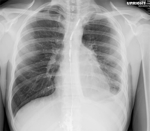 Repeat Thoracic Duct Embolization in Traumatic Thoracic Duct Injury: An ...