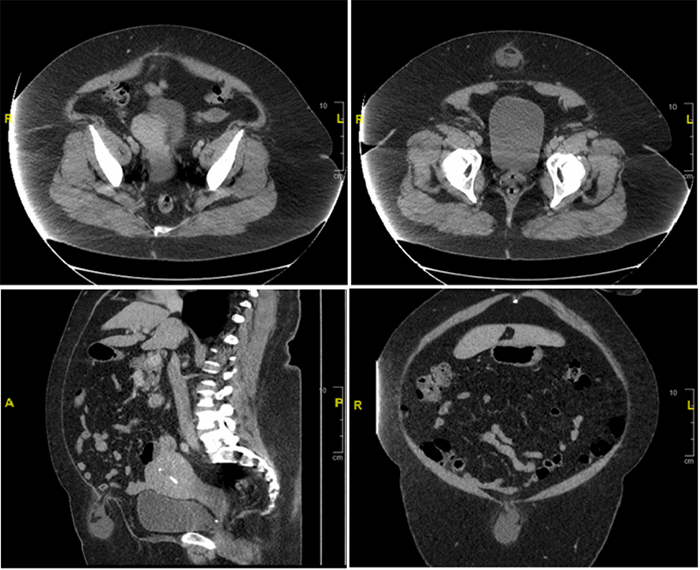 Rendezvous Procedure as an Alternative Treatment Strategy for Type C ...