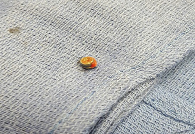 Gunshot Wound to Chest with Embolization of Pellet into the Left ...