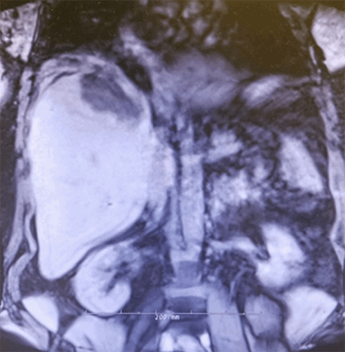 Transdiaphragmatic Liver Abscess Secondary to Streptococcus Milleri in ...
