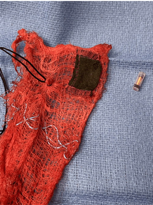 Retained Radiofrequency Tag Despite Normal Count | ACS