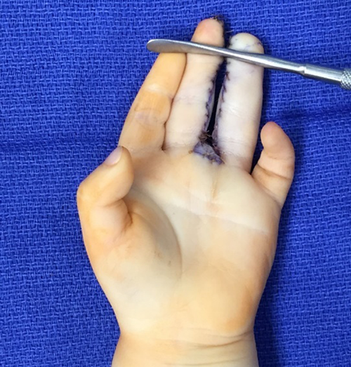 Syndactyly Repair with a Straight-Line Technique: A Case Series | ACS