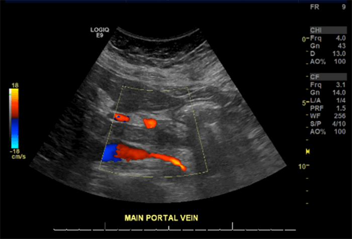 Extensive Portomesenteric Venous Thrombosis after Laparoscopic Sleeve ...