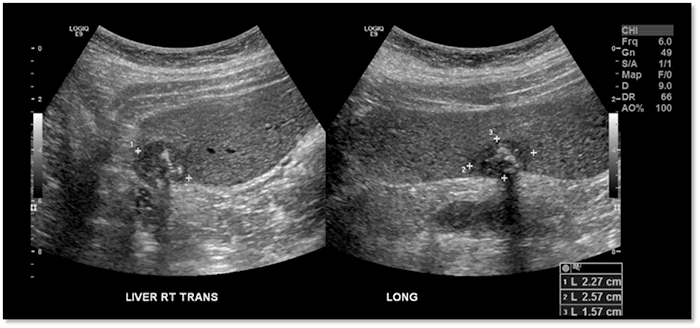 Retained Gallstone Presenting as Hepatic Mass | ACS