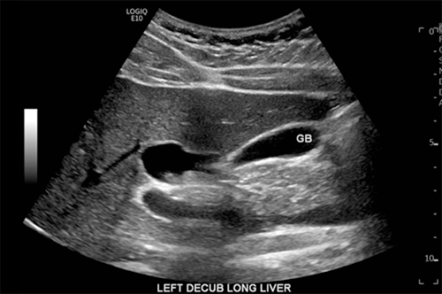Surgical Management of an Intrahepatic Type II Choledochal Cyst | ACS