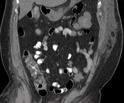 Microscopic Submucosal Lipomas with Mucosal Ulceration Can Be a Cause ...