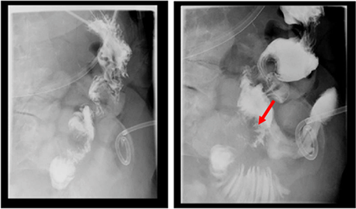 Upper Gi Series Ulcer