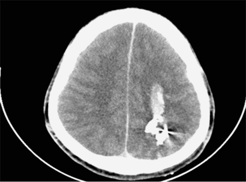 A Systematic Review of Neurogenic Pulmonary Edema in Traumatic Brain ...