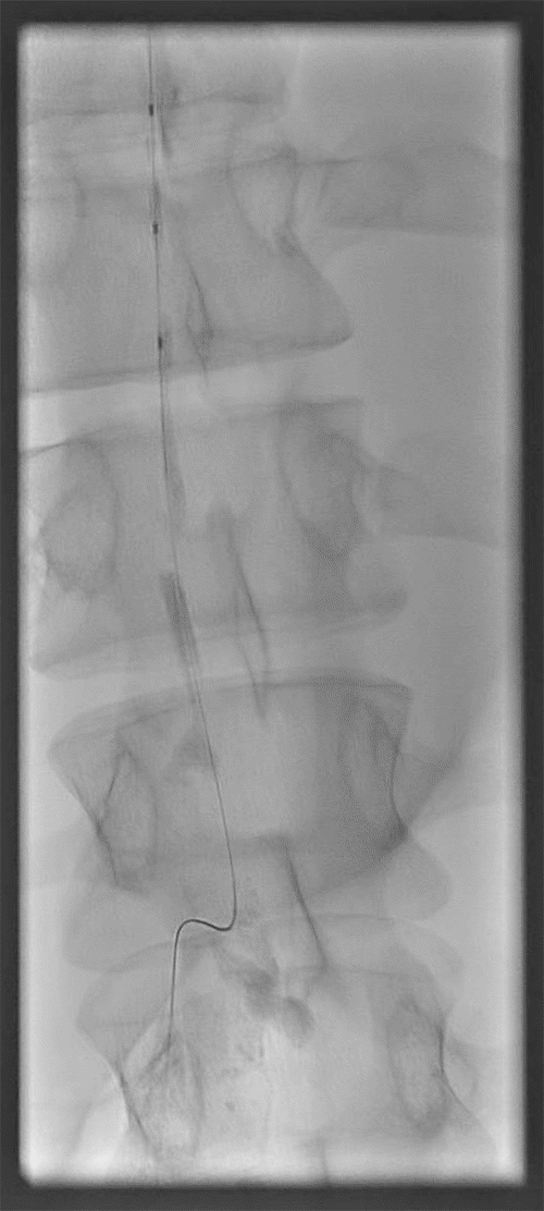 Repeat Thoracic Duct Embolization in Traumatic Thoracic Duct Injury: An ...