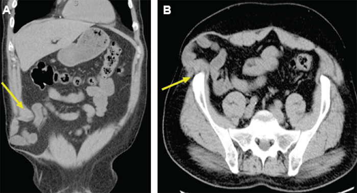 Lateral and Anterior Fascial Release with Onlay Mesh: An Elegant ...