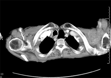 Aberrant Right Subclavian Artery as a Cause of Esophageal Traction ...