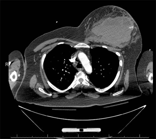 Traumatic Breast Hematoma Resulting in Class III Hemorrhagic Shock | ACS
