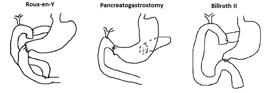 Endoscopic Management of Delayed Duodenojejunal Marginal Ulcer ...
