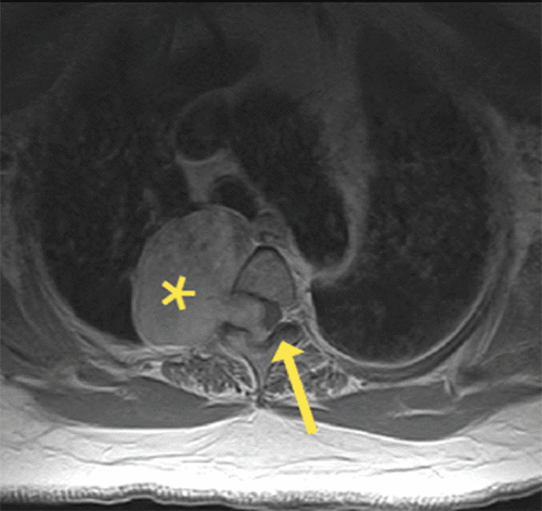 Decades Old: A Paraspinal Tumor with Intrathoracic Extension and ...