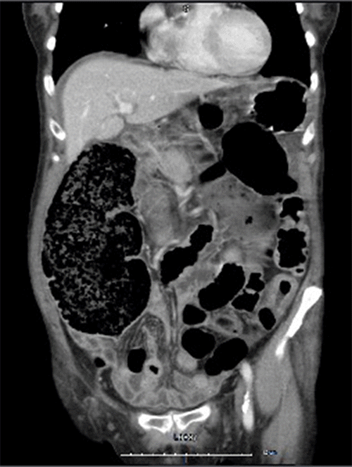 Surgical Intervention for Rapidly Progressing Obstruction Identified in ...