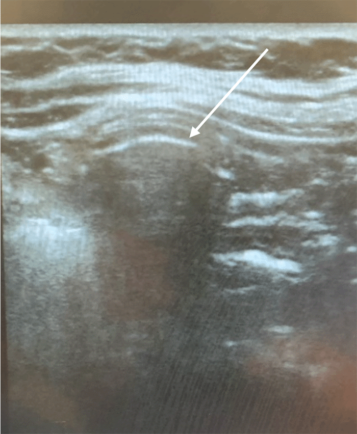 Assessing the Utility of Ultrasound-Assisted Percutaneous Gastrostomy ...