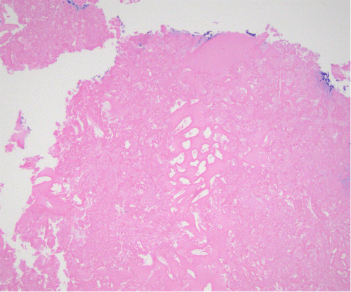 Delayed Absorption of Oxidized Cellulose (Surgicel®) Mimicking Residual ...