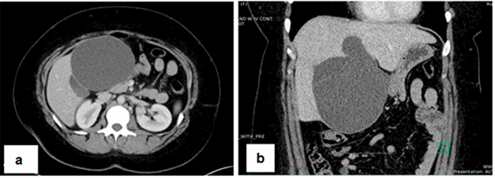 Benign Hepatic Cyst in the Setting of Markedly Elevated CA 19-9 | ACS