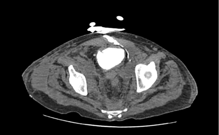 Vesico-cutaneous Fistula: A Rare Complication of Complex Pelvic Trauma ...