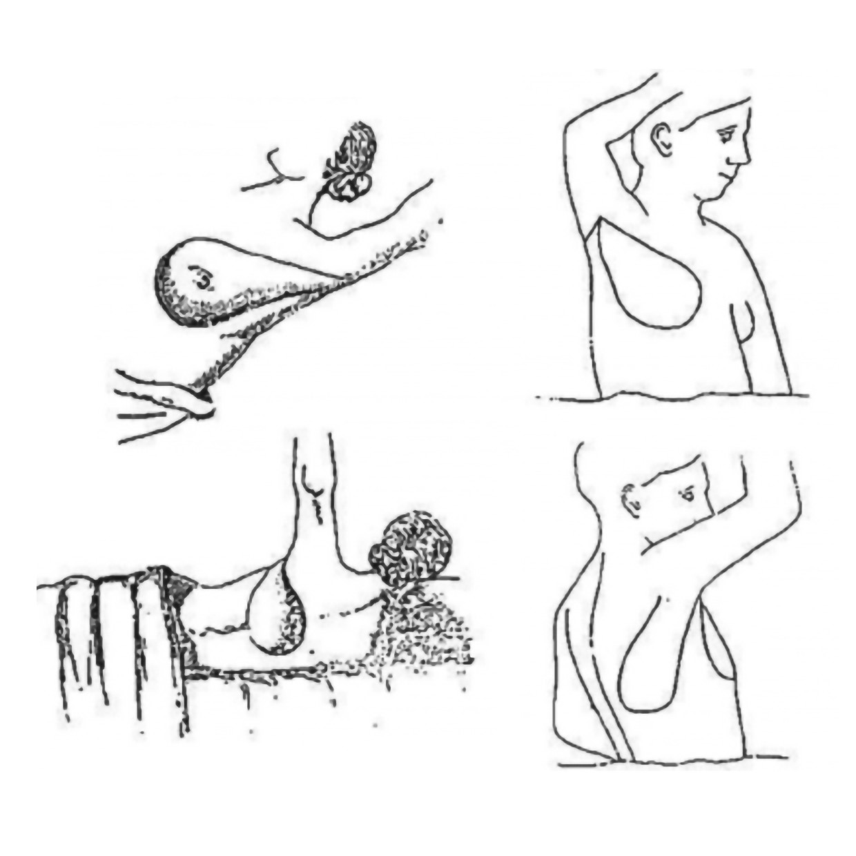 The History of Breast Reconstruction Is a Journey of Resilience | ACS