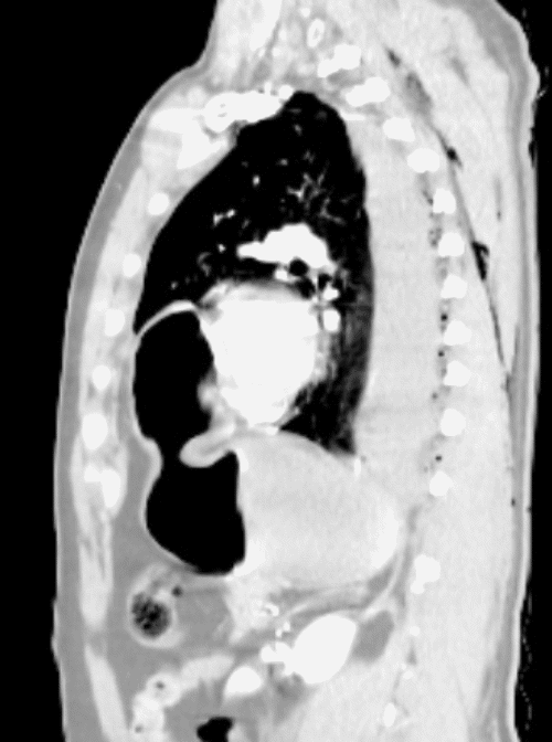 Laparoscopic Repair of Traumatic Intrapericardial Diaphragmatic Hernia ...