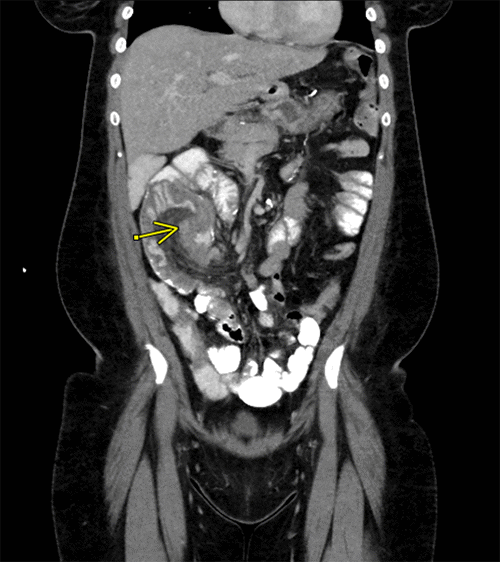 Recurrent Retrograde Intussusception Despite Revision of Jejunojejunal ...