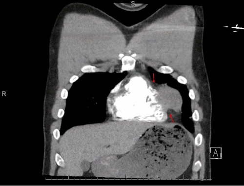 Cardiac Herniation After Blunt Trauma in the Setting of Remote ...