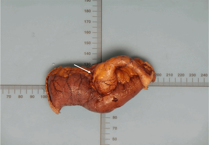Appendiceal Adenocarcinoma Presenting as Recurrent Small Bowel ...