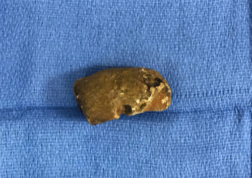Gallstone ileus | ACS